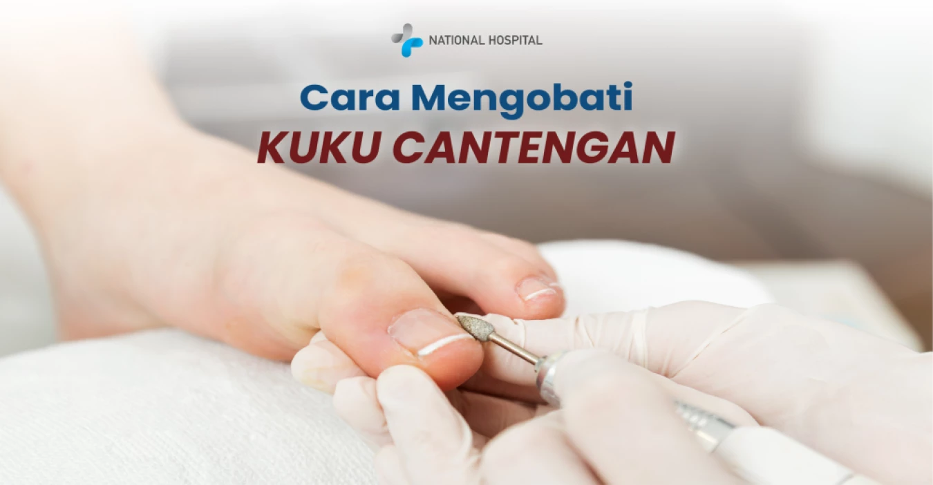 Cara Mengobati Cantengan Agar Tidak Bengkak dan Memicu Infeksi
