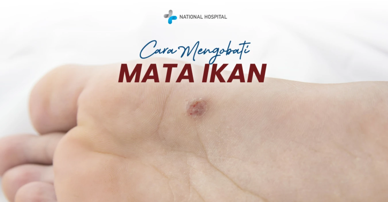 Apa itu Mata Ikan dan Cara Mengobati Mata Ikan