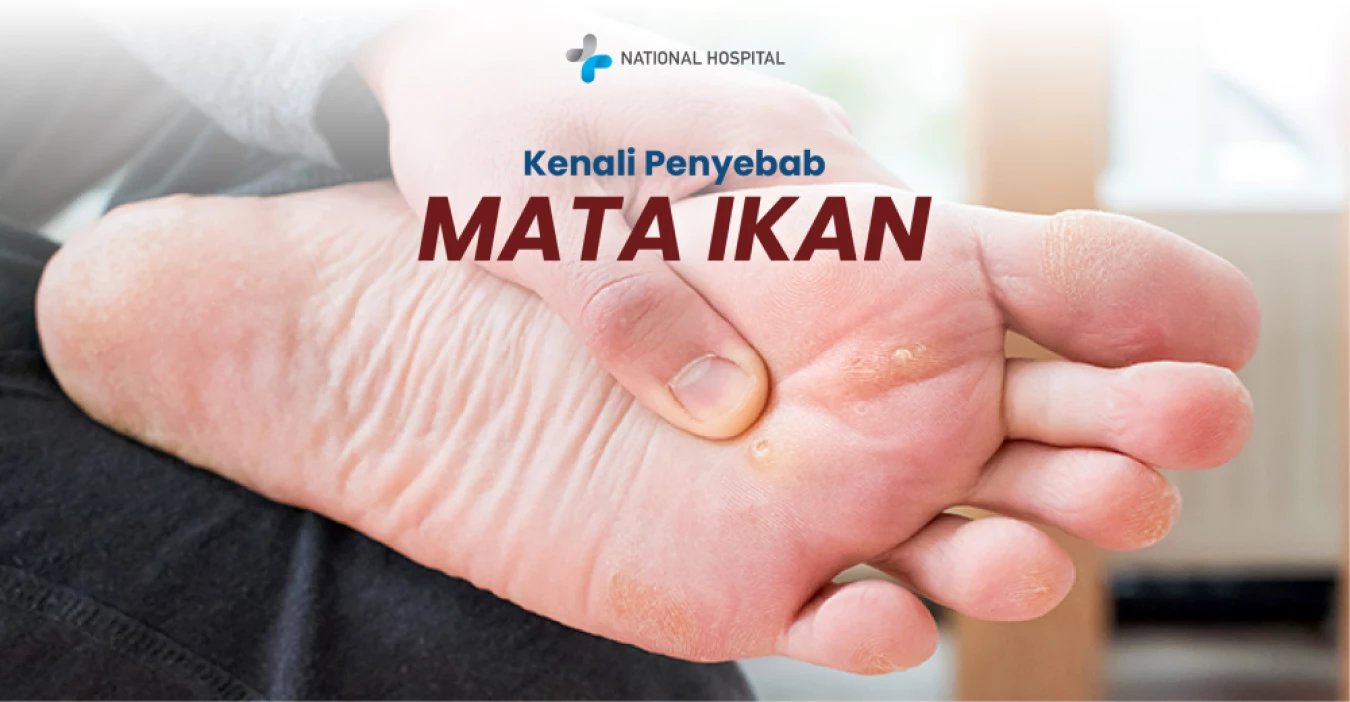 Kenali Penyebab Mata Ikan, Faktor Risiko, Gejala Awal dan Pencegahannya
