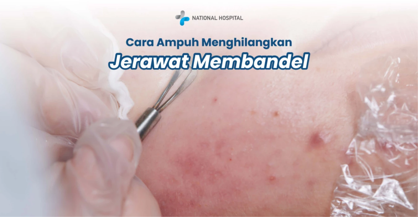 Cara Ampuh Menghilangkan Jerawat Membandel Secara Medis